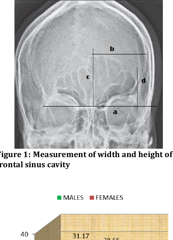 Table 1 From Morphometric Analysis Of Frontal Sinus Dimensions Using