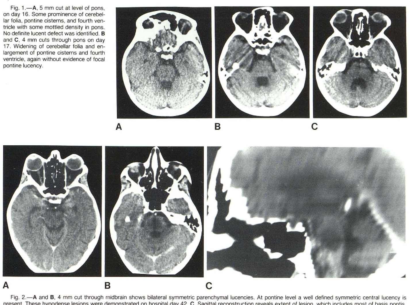 Figure 1 From Evolution Of Central Pontine Myelinolysis On Ct