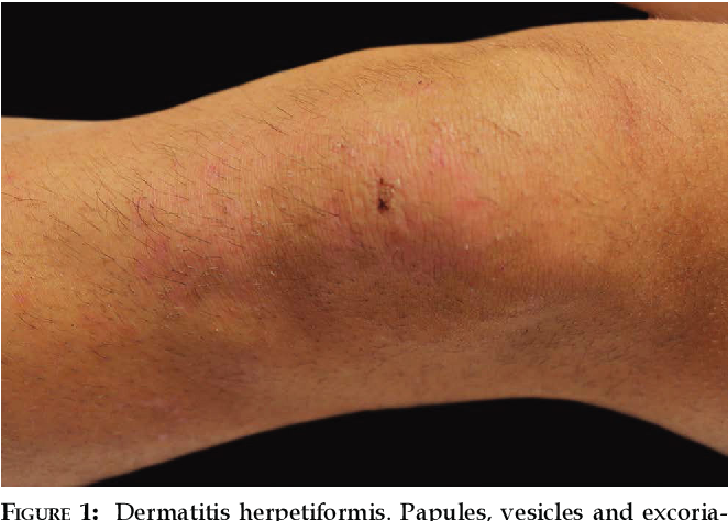 Figure 1 From Dermatitis Herpetiformis In An Adolescent Patient