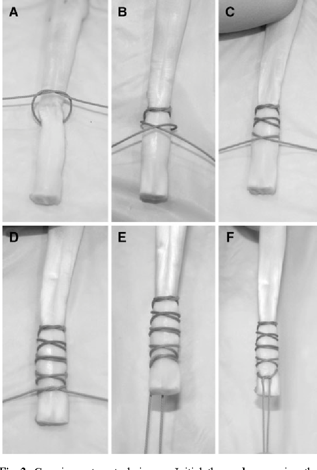 Whip Stitch Versus Grasping Suture For Tendon Autograft Semantic Scholar