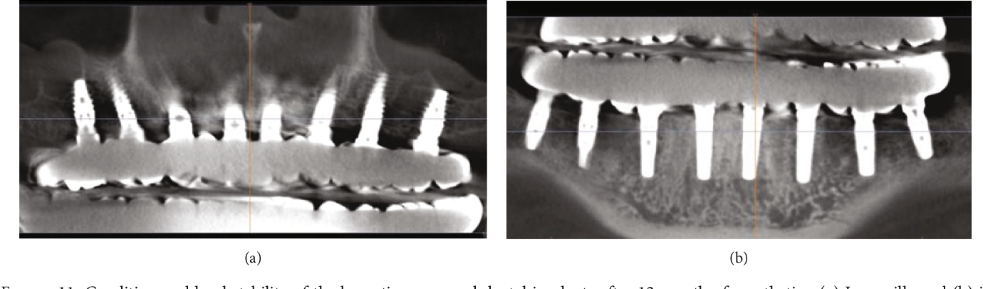 Figure 2 From Full Mouth Screw Retained Implant Supported