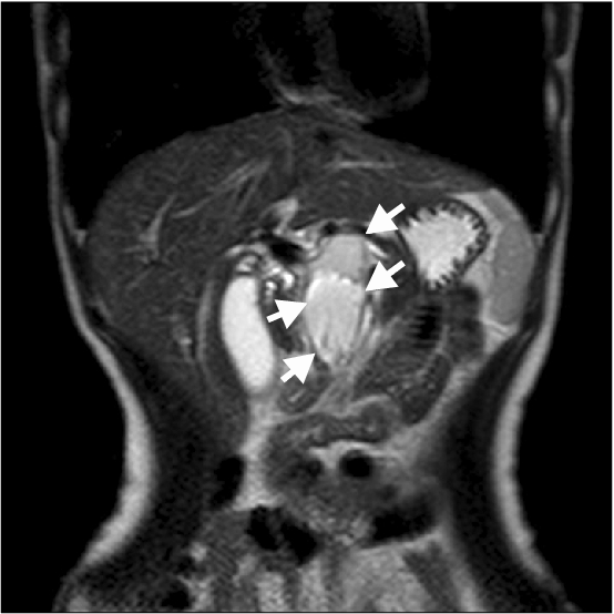 Figure 1 From A Case Of Primary Retroperitoneal Mucinous Cystadenoma