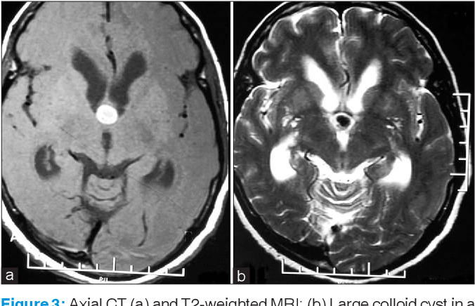 Figure 1 From Interhemispheric Transcallosal Transforaminal Approach