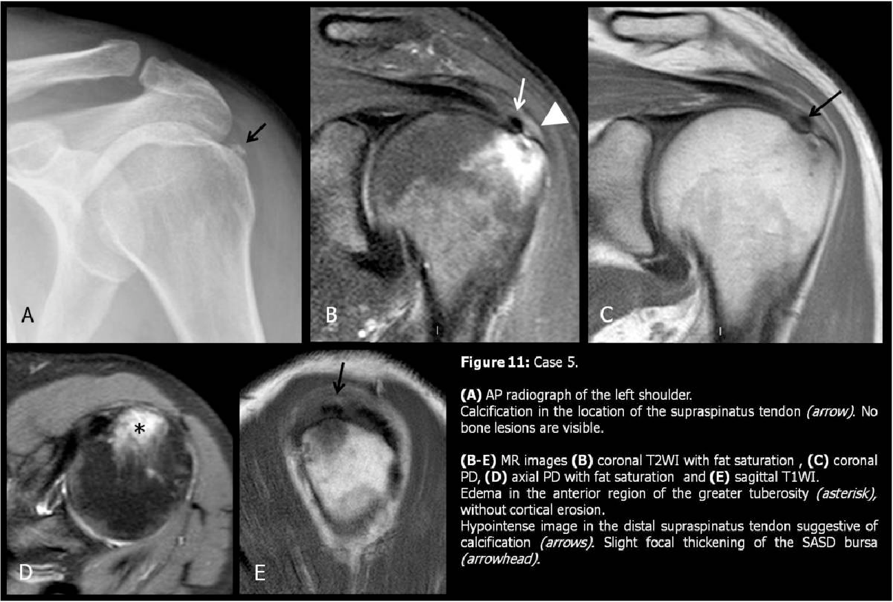 Rotator Cuff Calcific Tendonitis