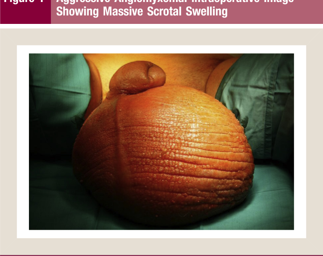 Figure 1 From Aggressive Angiomyxoma As A Rare Differential Diagnosis