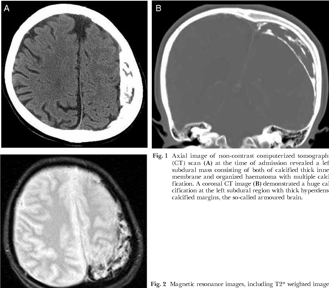 Figure 1 From Organized Chronic Subdural Haematoma With A Thick