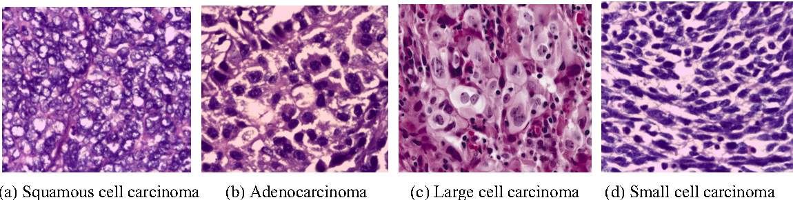 Normal Lung Tissue Vs Cancerous Lung Tissue Cancerwalls