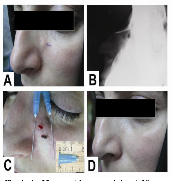 Figure 4 From Surgical Removal Of Neglected Soft Tissue Foreign Bodies