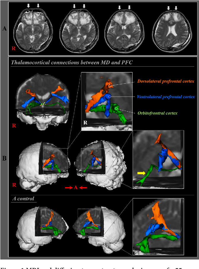 Injury Of Thalamocortical Connection Between The Mediodorsal Nucleus Of