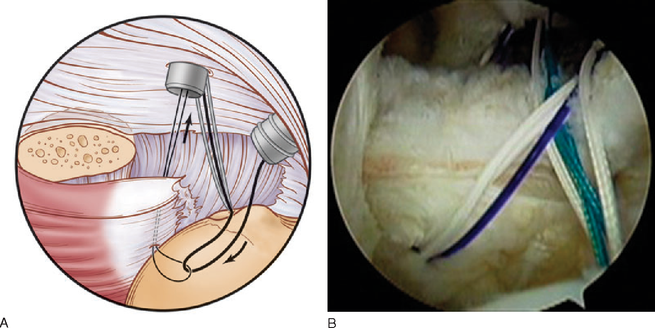 Pdf Arthroscopic Subscapularis Repair Semantic Scholar