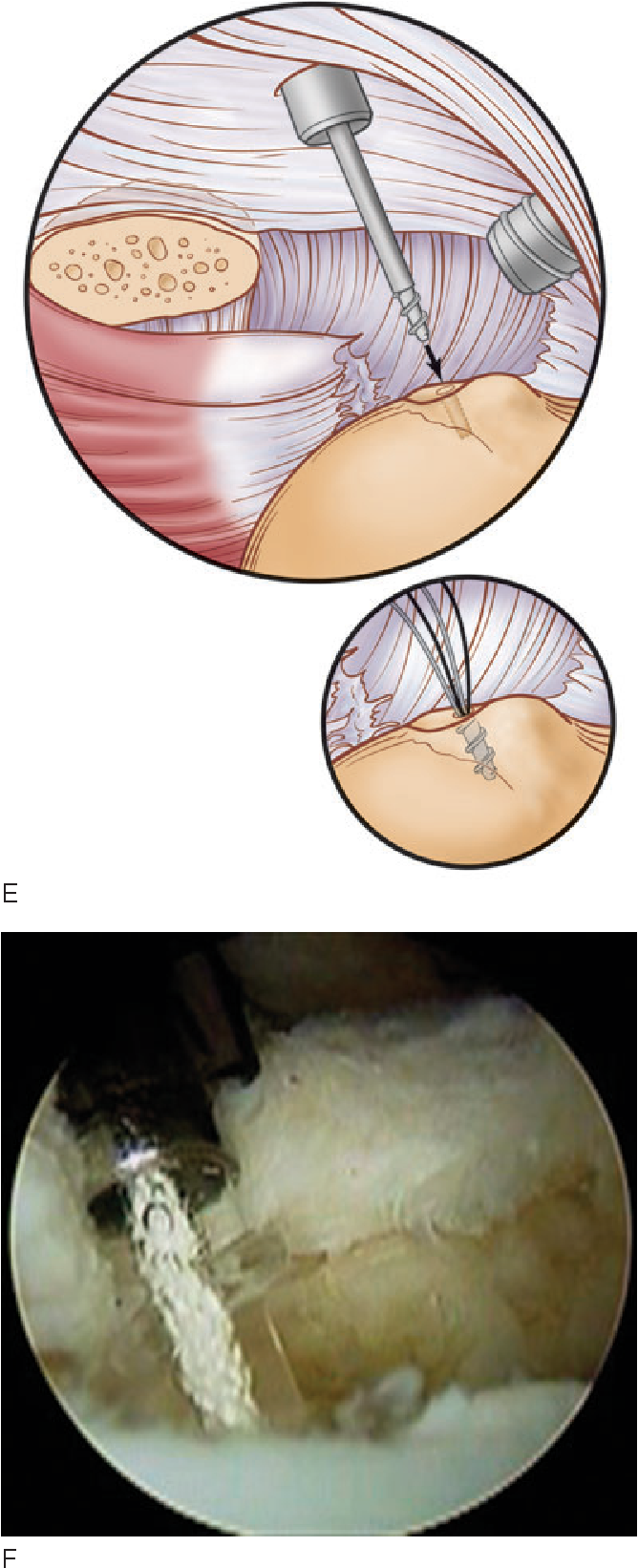 Pdf Arthroscopic Subscapularis Repair Semantic Scholar