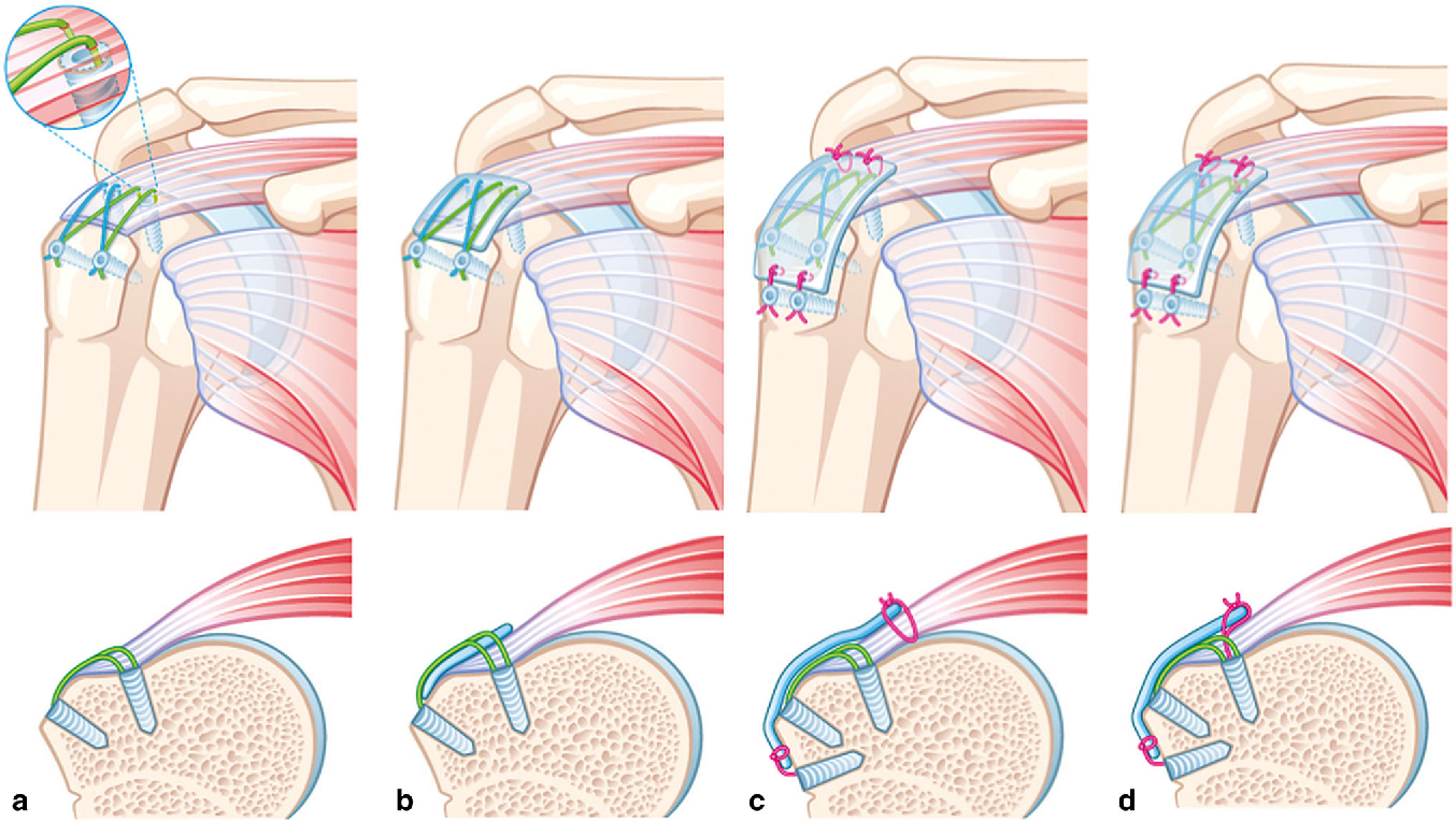 Patch Augmented Rotator Cuff Repair Influence Of The Patch Fixation