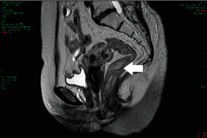 Figure 1 From Transanal Minimally Invasive Surgery For Total Mesorectal