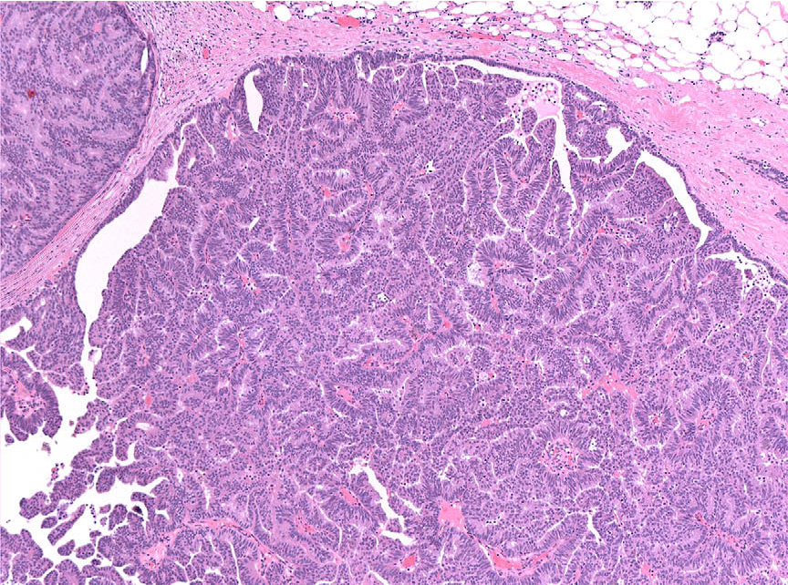 Figure 3 From Encapsulated Papillary Carcinoma Of The Breast