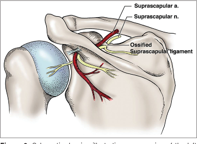 Figure 2 From Ossification Of The Suprascapular Ligament A Risk Factor