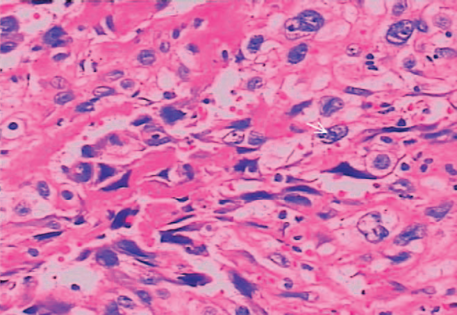 Figure 1 From Extrauterine Choriocarcinoma Of The Greater Omentum After