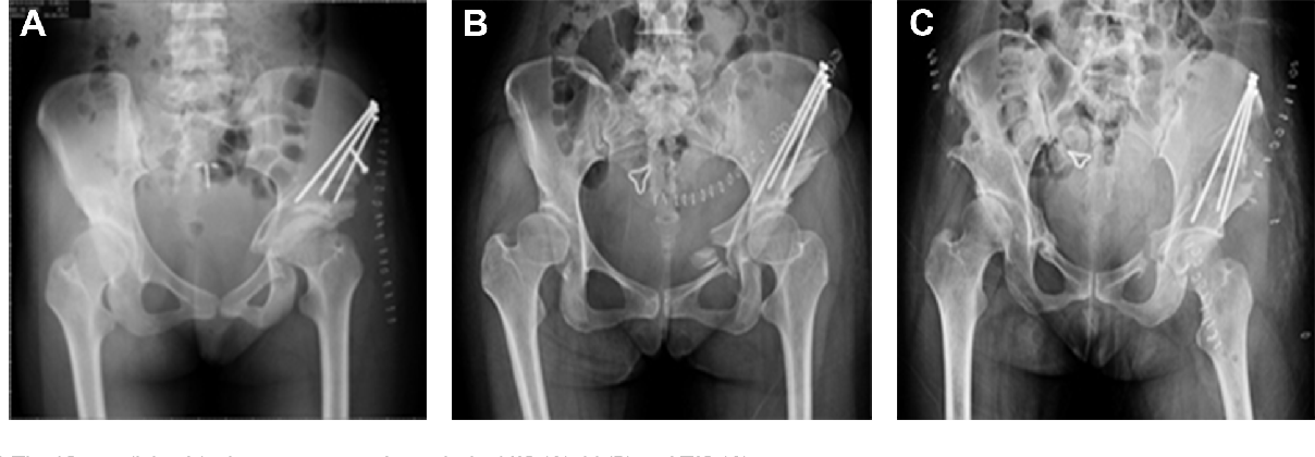 Table 2 From Comparison Of Three Approaches Of Bernese Periacetabular