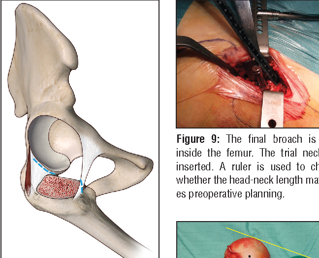 Figure 3 From Anterior Approach In Total Hip Replacement Semantic