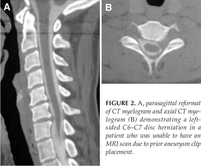 Cervical Radiculopathy Pathophysiology Presentation And Clinical Hot