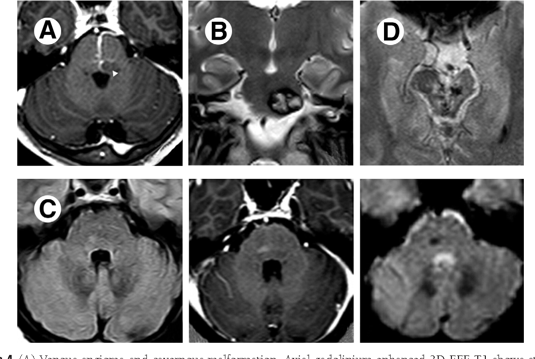 Pdf Differential Diagnosis Of T2 Hyperintense Brainstem Lesions Part