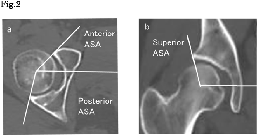 Table 1 From Sex Related Differences In Pelvic Morphology In Acetabular