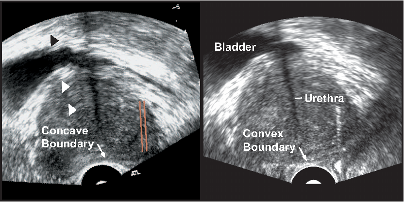 Transrectal Ultrasound Of Prostate Telegraph