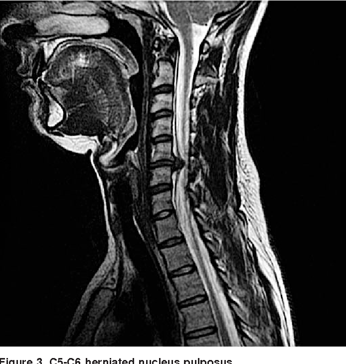 Figure 1 From Management Of Cervical Spine Injuries In Athletes