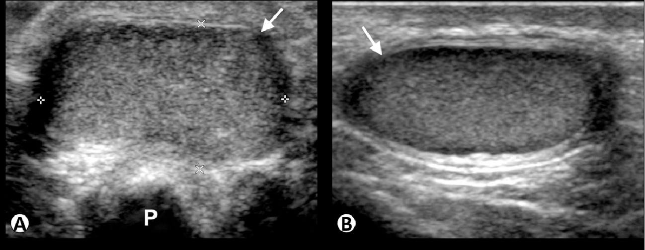 Diagnostic Approach To Ultrasound Of Soft Tissues Masses In The Hand