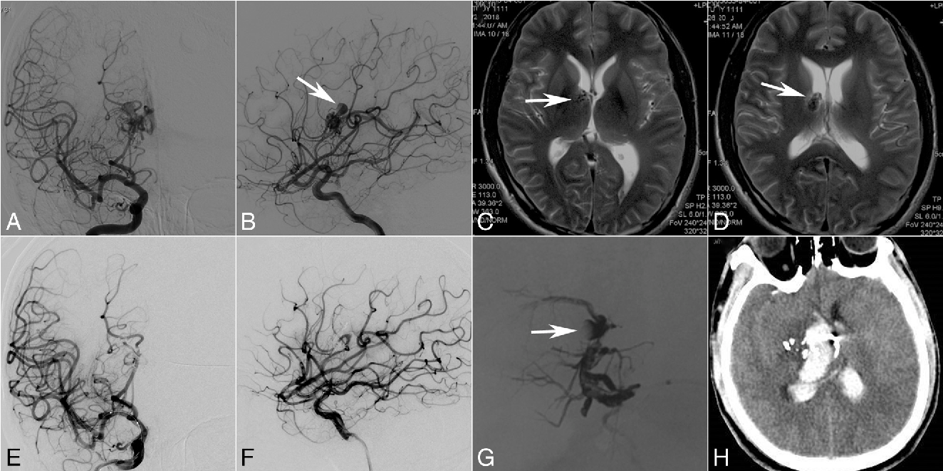 Table 2 From Safety And Efficacy Of Transvenous Embolization Of