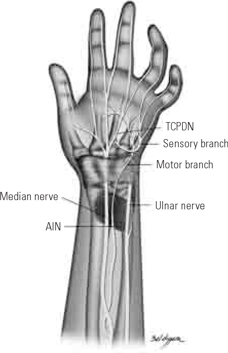 Figure 1 From Distal Anterior Interosseous Nerve Transfer To The Deep