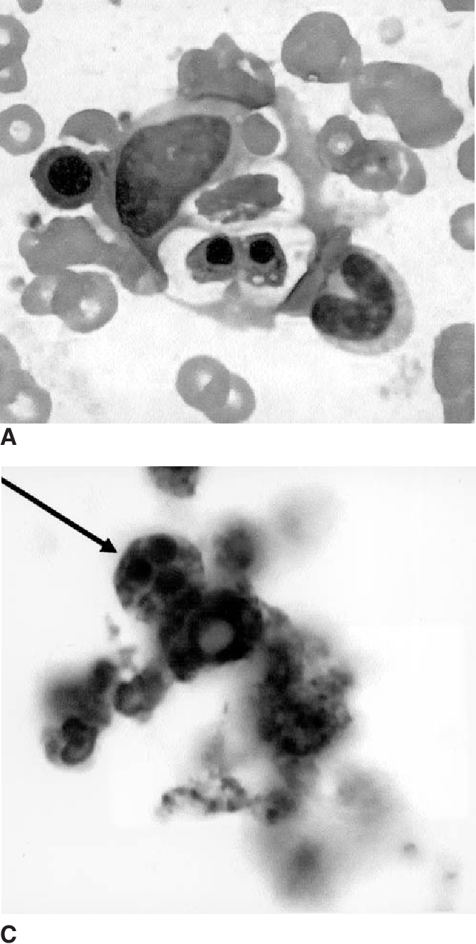 Secondary Hemophagocytic Lymphohistiocytosis Semantic Scholar