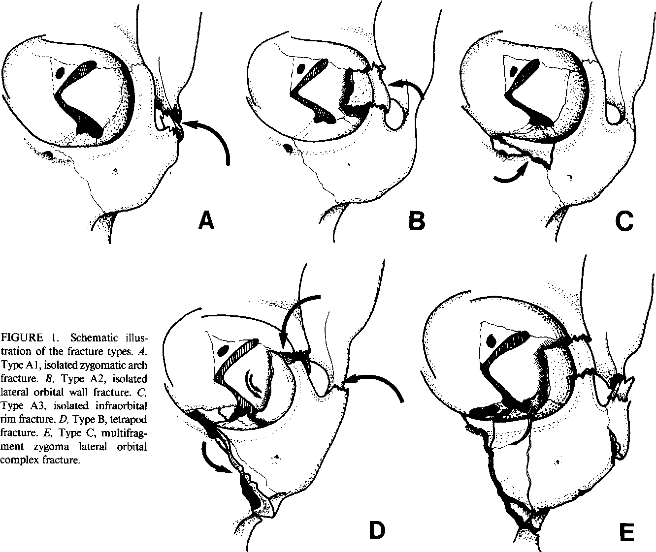 Zygomatic Arch Fracture Treatment