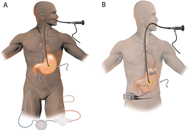 Figure 1 From Percutaneous Endoscopic Gastrostomy Tube Placement In