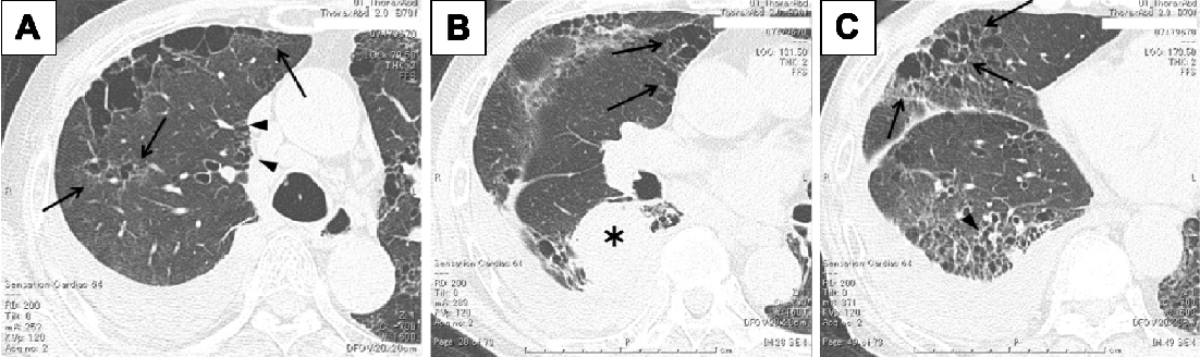 Figure 1 From Pathological And Radiological Correlation In An Autopsy