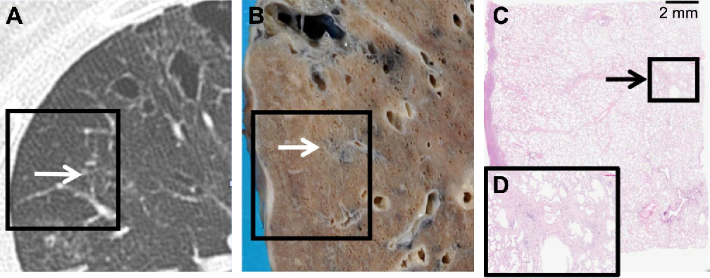 Figure 3 From Pathological And Radiological Correlation In An Autopsy