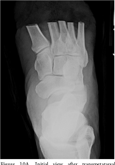 Figure 1 From Total Tibialis Anterior Tendon Transfers In High Risk