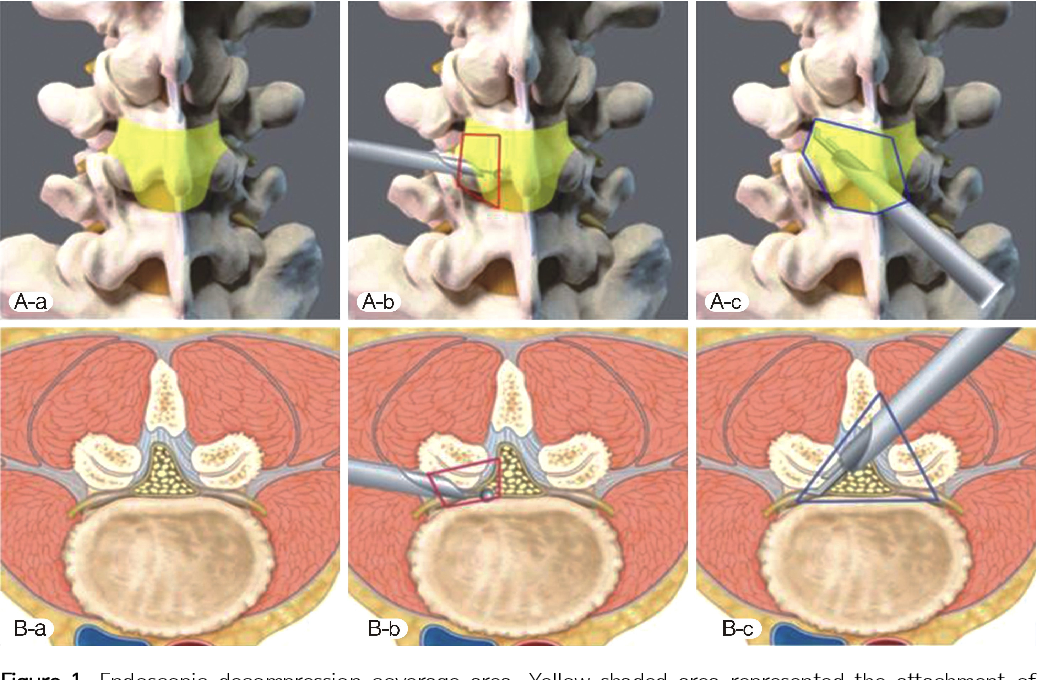 Figure 5 From Clinical Results And Review Of Techniques Of Lumbar