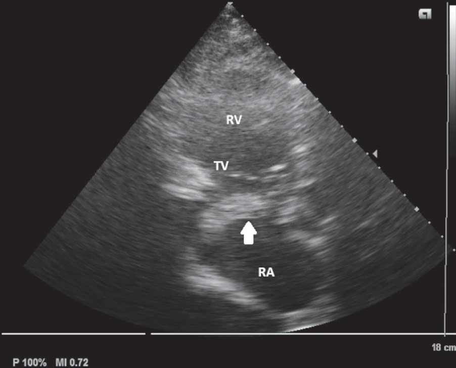 Figure 1 From Acute Massive Pulmonary Embolism With Direct