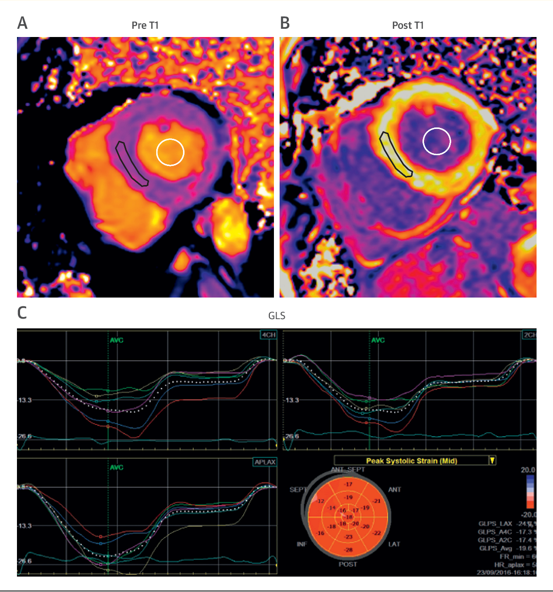 Figure 1 From Assessment Of Myocardial Fibrosis Using Multimodality