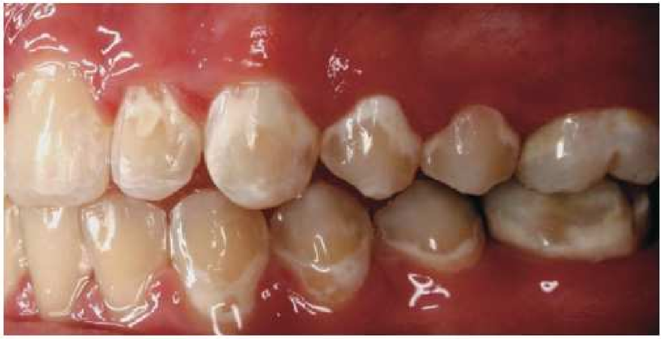 White Spot Lesions After Orthodontic Treatment With F