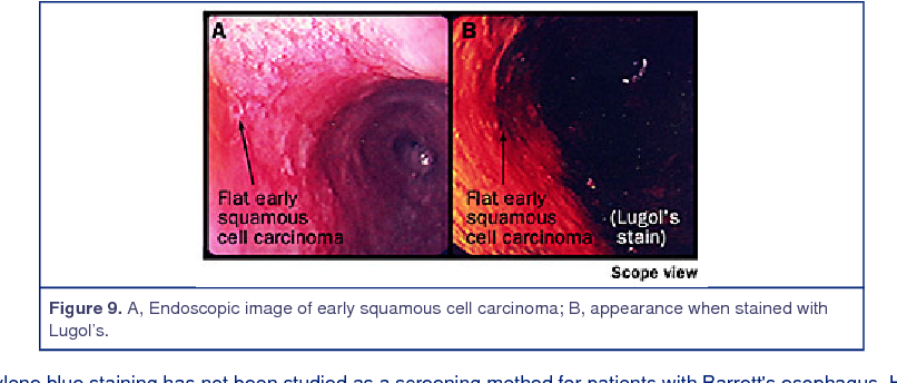 Figure 6 From Barrett S Esophagus Diagnosis Radiographic Diagnosis