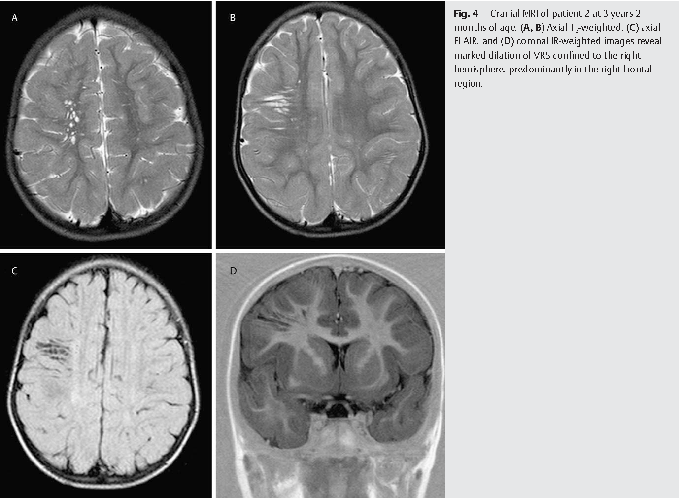 Figure 1 From Unilateral Dilation Of Virchow Robin Spaces In Early