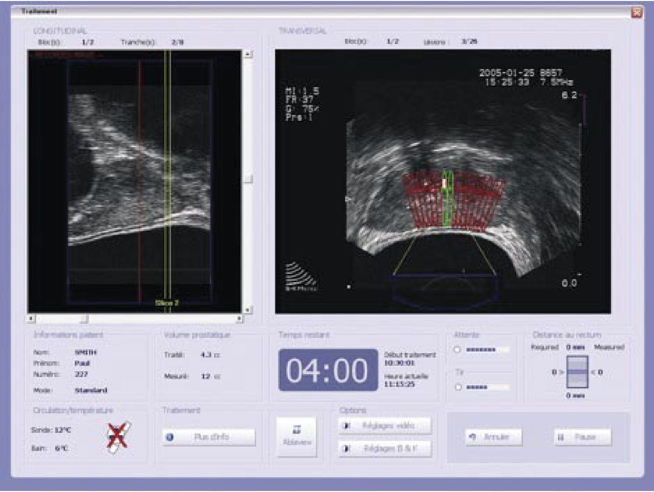 Figure 3 From Transrectal High Intensity Focused Ultrasound For Local