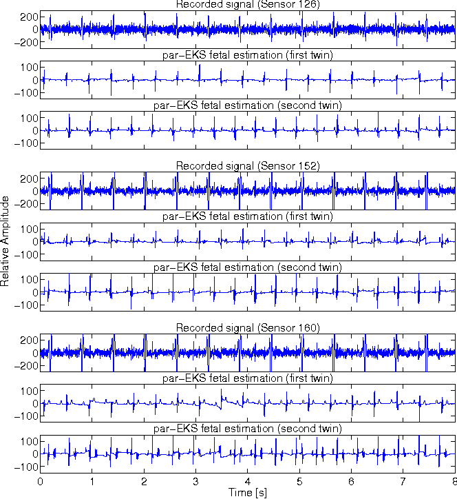 Figure 1 From Fetal Ecg Extraction By Extended State Kalman Filtering