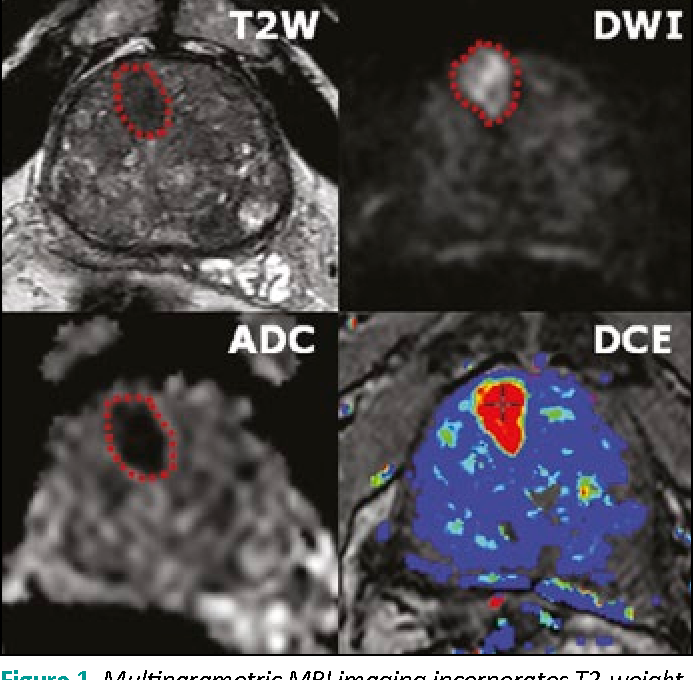 Pdf Multiparametric Mri And Targeted Prostate Biopsy Improvements In