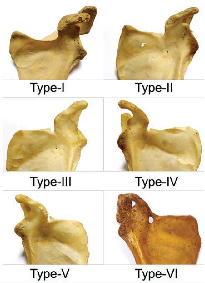 Correlation Of Suprascapular Notch Morphology With 49 Off