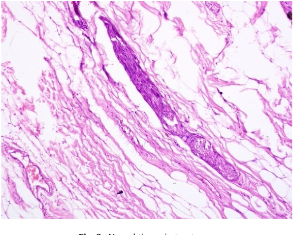 Figure 1 From Massive Primary Retroperitoneal Immature Teratoma In An