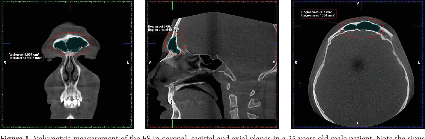 Table 1 From Cbct Assessment Of The Frontal Sinus Volume And Anatomical