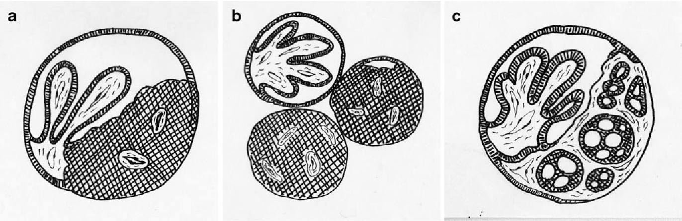 Myoepithelial Cells In Solid Variant Of Intraductal Papillary Carcinoma