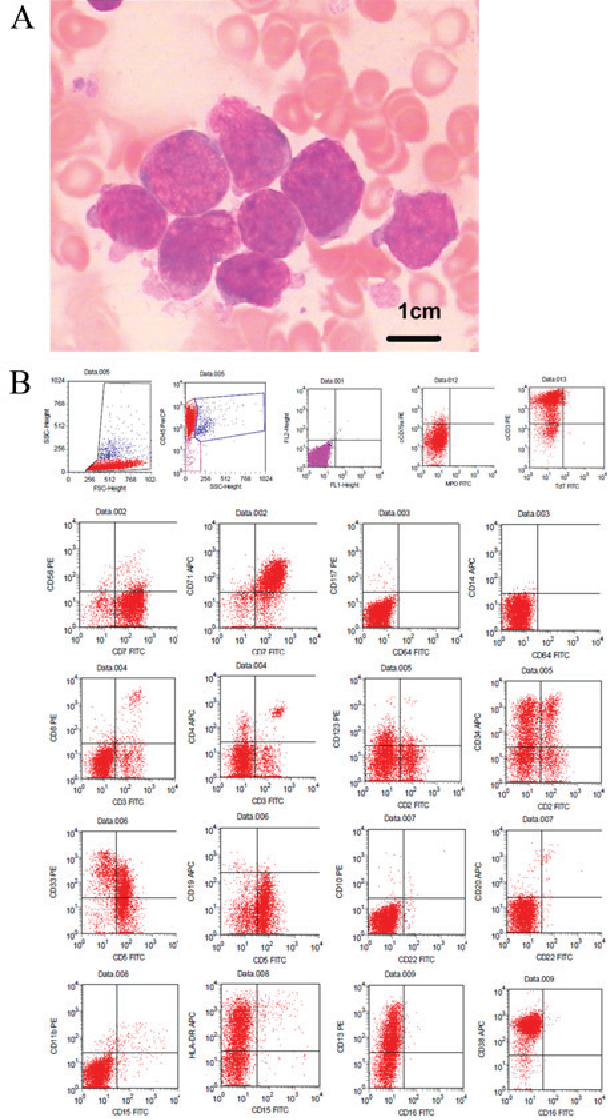 Figure 1 From Dasatinib And Chemotherapy In A Patient With Early T Cell